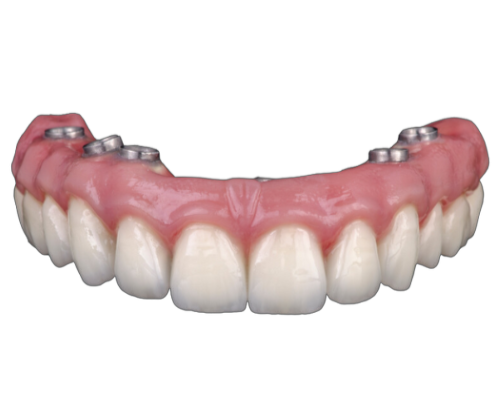 Implantes Dentários – Clínica Dental Concept
